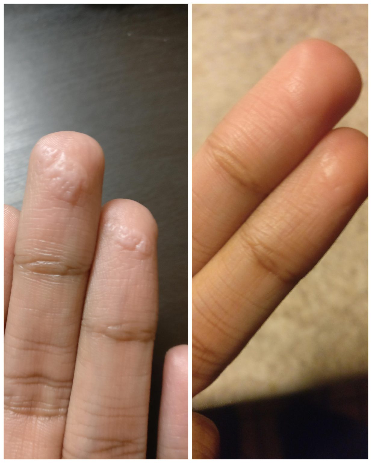 What to Do If You Touch a Hot Pan: Quick Soothing Tips - kitchen Bap